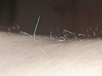 What Are Theses White Plugs Attached To Scab MY SKIN