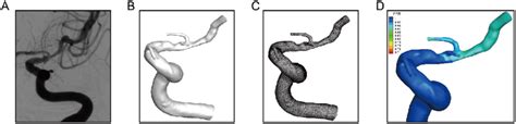 3d Model Reconstruction Based On 3d Angiography Of Intracranial