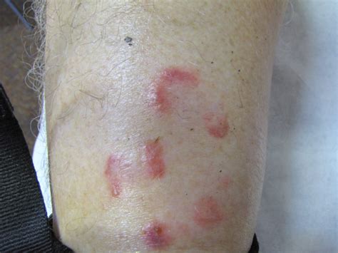 Global Skin Atlas Diagnosis Detail