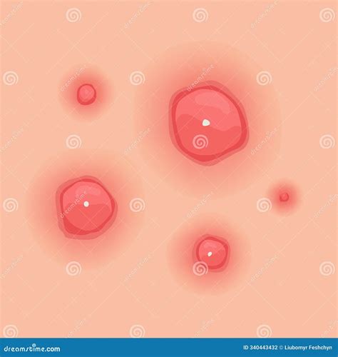 Understanding Type Of Acne A Comprehensive Visual Guide For Everyone Stock Illustration