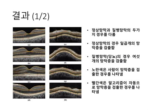 Retinal Layer Segmentation Pdf