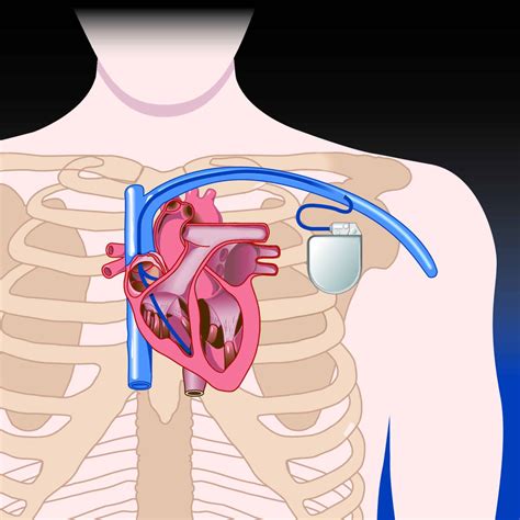 Cardiac Rhythm Device Infections Ct Imaging And Replacement Timing