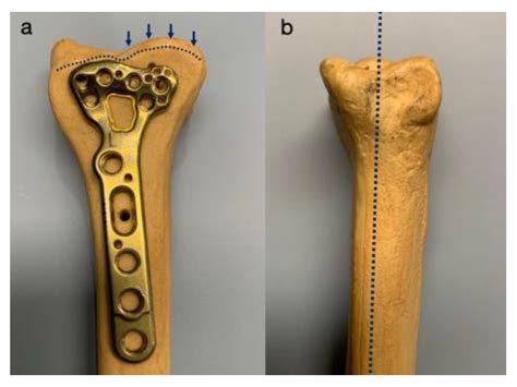 Radius Anatomy