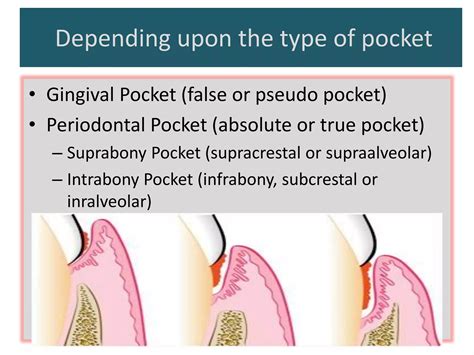 Periodontal Pocket Pptx