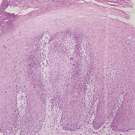 A Psoriasiform Plaques With Yellowish White Scales Over The Left Ear B Download Scientific