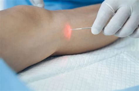 Laser Treatment For Varicose Veins Spandan Hospital And Ccc