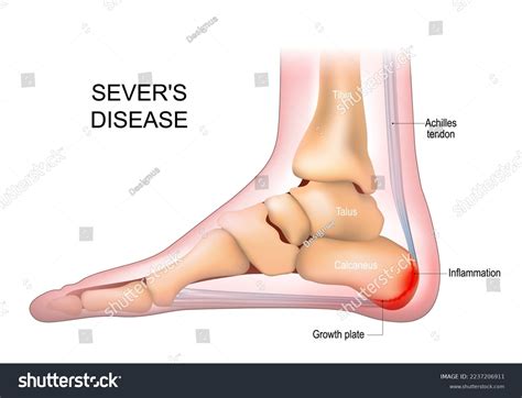 Severs Disease Calcaneus Apophysitis Inflammation Back Stock Vector
