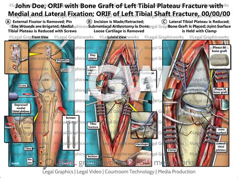 Orif With Bone Graft Of Left Tibial Plateau Fracture With Medial And L