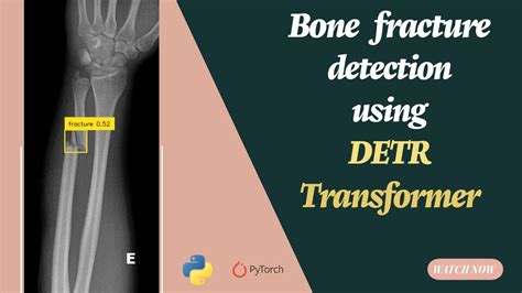 Object Detection Using Detection Transformer Detr For Bone Fraction Dataset Youtube