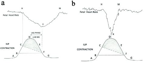 A Schematic Drawing Of Fhr Deceleration Resulting From Peripheral
