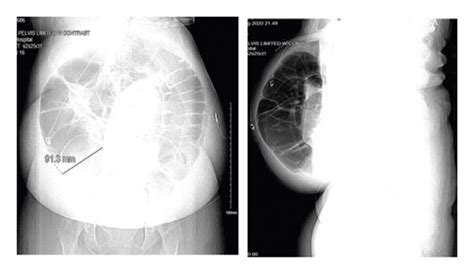 Cat Scan With Intravenous Contrast Showing Dilated Loops Of Bowel Download Scientific Diagram