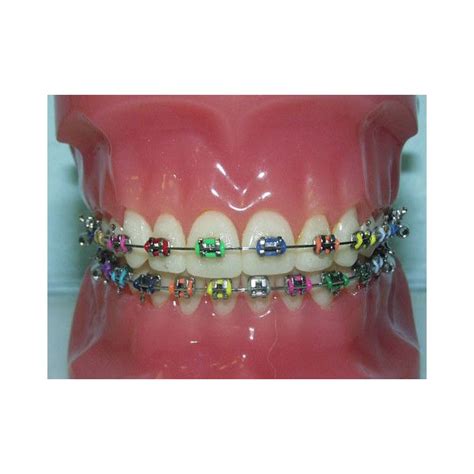 27 Best Customized Braces Images On Pinterest Braces Orthodontics
