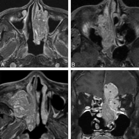Pdf Sinonasal Inverted Papilloma Value Of Convoluted Cerebriform Pattern On Mr Imaging