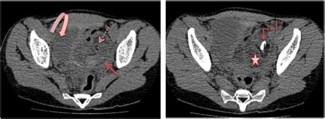 Axial Ct Heterogeneous Left Ovarian Mass Arrow With Fat