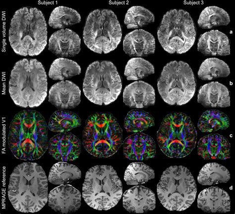 Diffusion MRI Results Of Multiple Subjects Using The Proposed Method Download Scientific