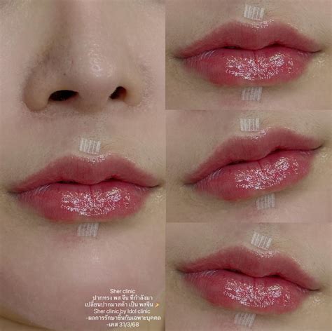 โปรแกรม พส จีน หลังทำทันที แบบ เรียลๆ 🤍👄 ฟิลเลอร์ปาก ปากทรง พส จีน