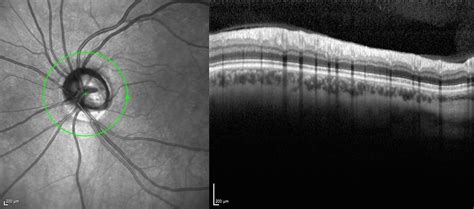 Glaucoma Research Group Dalhousie University