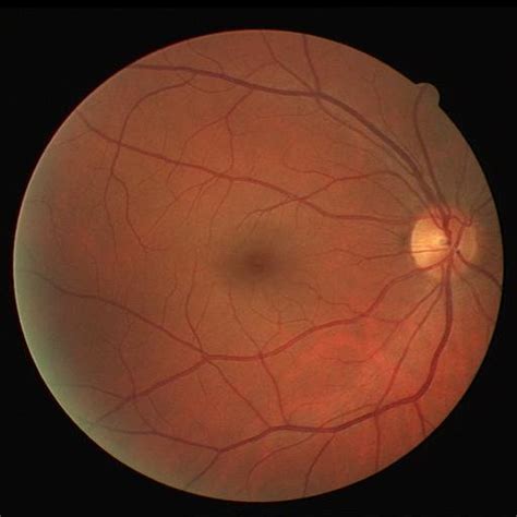 Segmentation Of An Image From The Drive Dataset A Input Image B Download Scientific