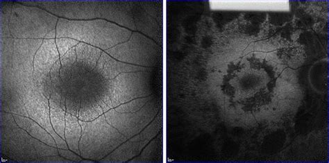 Revitalizing Vision Metabolome Rejuvenation Can Slow Retinal