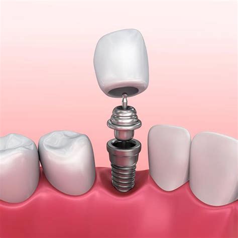 Single Tooth Vs Multiple Teeth Replacement Options Dental Care Laurel Lakes