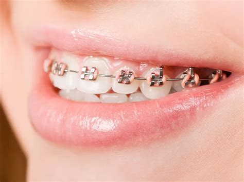 What Is An Overbite Education With Fillmore Dental Group