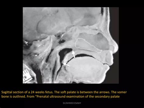 5 Fetal Face Ultrasound Dr Ahmed Esawy Pdf