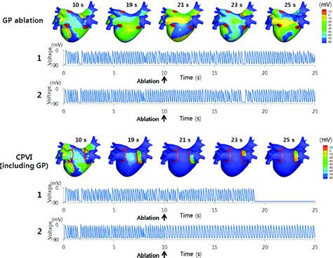 Two Patterns Of Virtual Ablations Ganglionated Plexus Gp Only