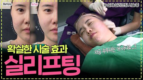 실제 실리프팅 시술 모습 공개 확실한 시술 효과가 궁금하시다면 Youtube