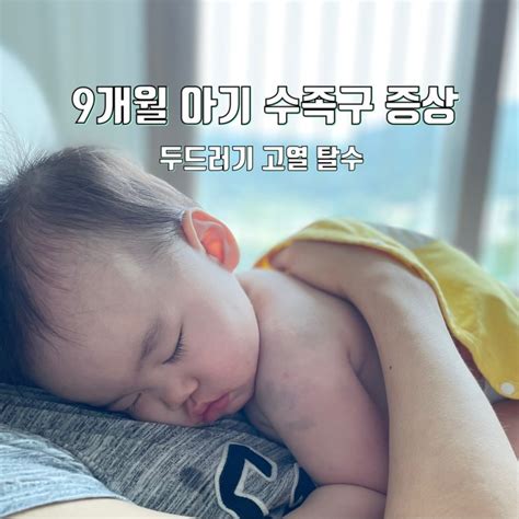 9개월 아기 수족구 잠복기 수족구 초기 증상 두드러기 고열 탈수 네이버 블로그
