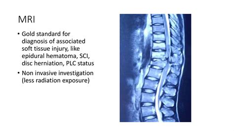 Fractures And Dislocation Spine Pptx