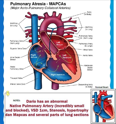 His Rare Case Of Chd Tetralogy Of Fallot Tof With Pa And Mapcas