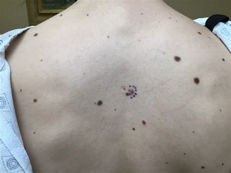 Dysplastic Melanocytic Naevus