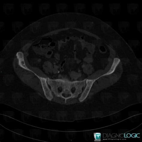Radiology Case Mastocytosis X Rays Ct Diagnologic