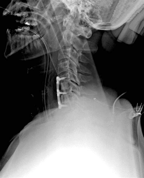 Dr Jonathan Citows Innovations The American Center For Spine And