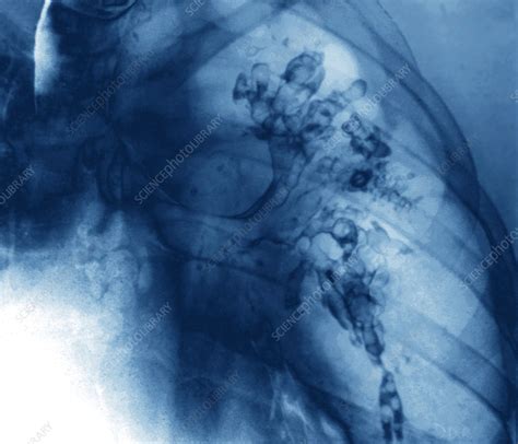 Bronchiectasis X Ray Stock Image M120 0172 Science Photo Library