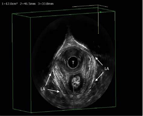 three dimensional transvaginal ultrasound image obtained with a download scientific diagram