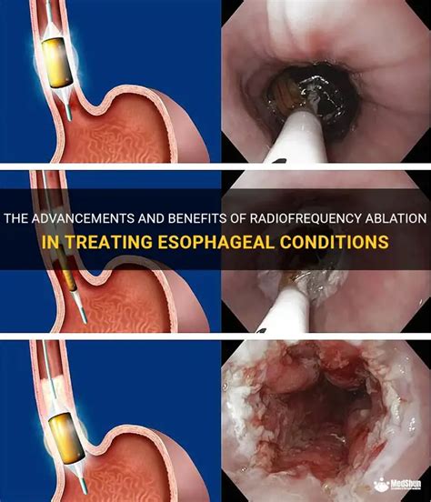 The Advancements And Benefits Of Radiofrequency Ablation In Treating Esophageal Conditions Medshun