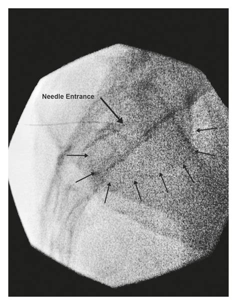 Lateral View Of Fco Needle Placement Large Arrow With Arthrogram Download Scientific Diagram