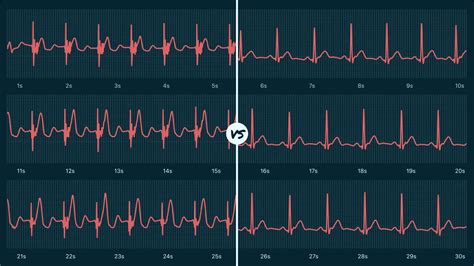 Paced Rhythm Vs Sinus Rhythm On Your Watch Ecg Qaly