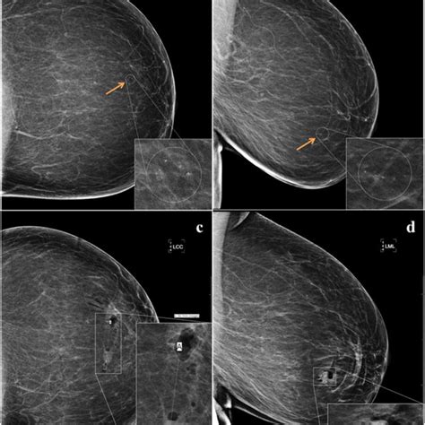1 A 66 Year Old Female 7 Months Out From Lumpectomy Sentinel Lymph Download Scientific