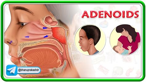 Adenoids Pharyngeal Tonsils Etiology Clinical Features Diagnosis