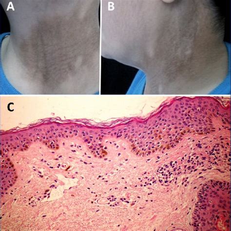 Pdf Linear Atrophoderma Of Moulin On The Neck