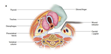 Thyroid Anatomy Cross Section Cross Section Of Thyroid Gland Done By