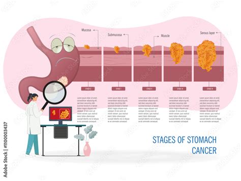 Stages Of Stomach Cancer Explained Visuallynfographic Showing The