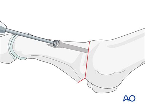 Mtp Joint Fusion For Complete Articular Fractures Of The Proximal Hallux