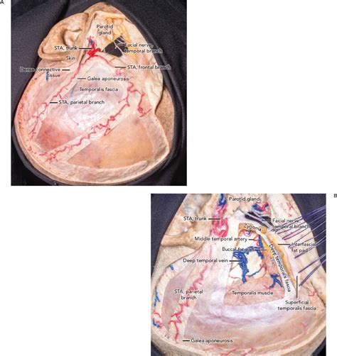 Extracranial Intracranial Bypass Neupsy Key