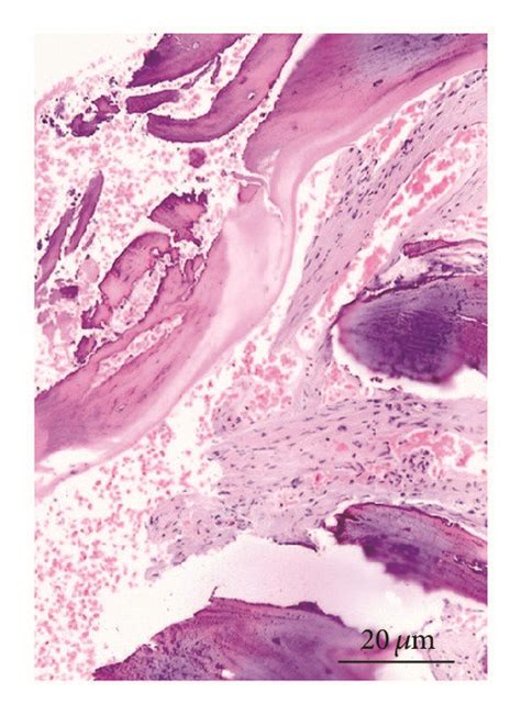 Bone Biopsy Illustrating Socket Healing 4 Months After The Ridge