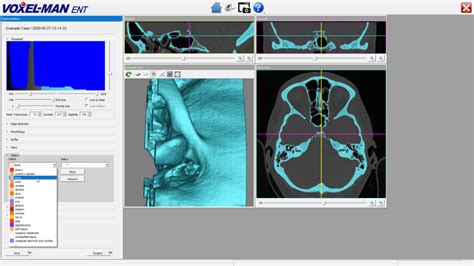 Voxel Man My Cases Surgical Training Cases From Ct And Cbct
