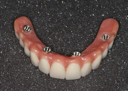 Teeth In A Day Smile Creation Dental