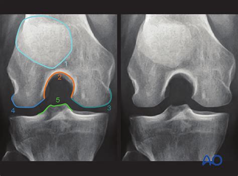 Intercondylar Notch View